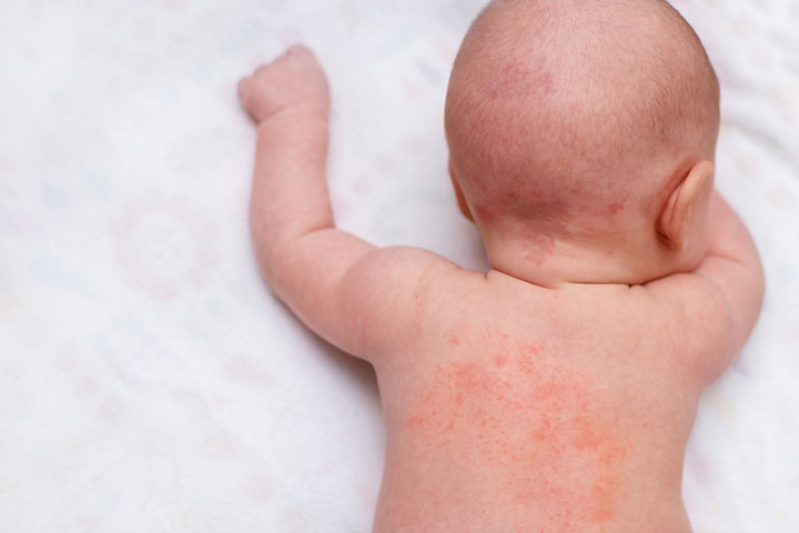 Anaphylaxis In Babies: Symptoms, Causes And Treatment - UsParenting.com