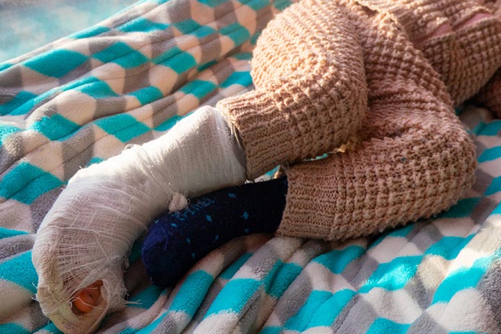 Toddler Fracture: Causes, Symptoms And Treatment - UsParenting.com